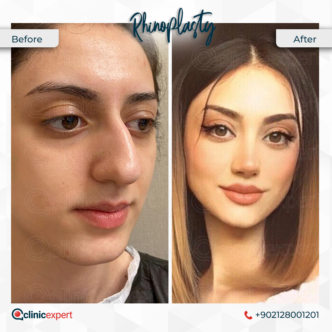 Things to Know About Nose Job in Turkey | ClinicExpert
