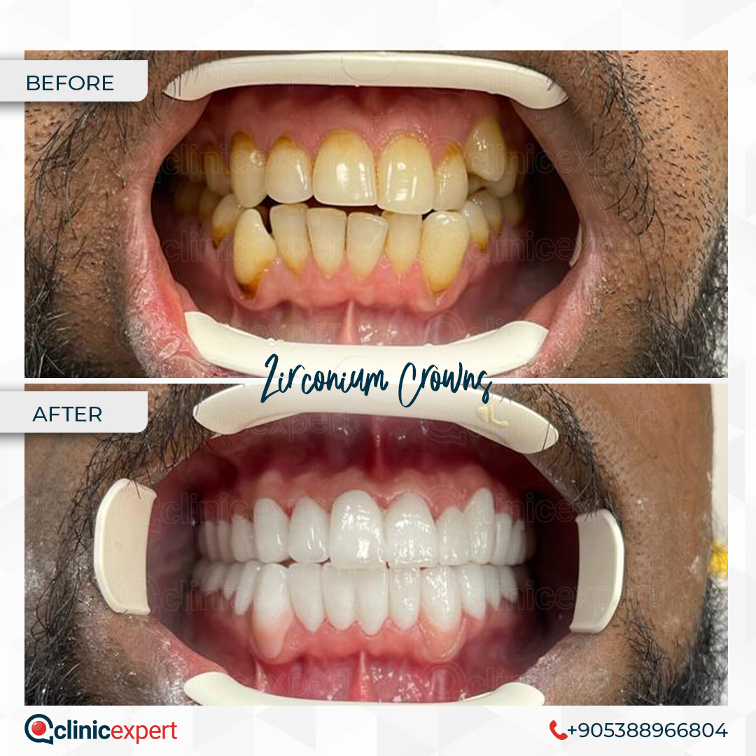 Porcelain Veneers vs. Zirconia Crowns | ClinicExpert